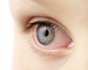 Les conjonctivites, la conjonctivite